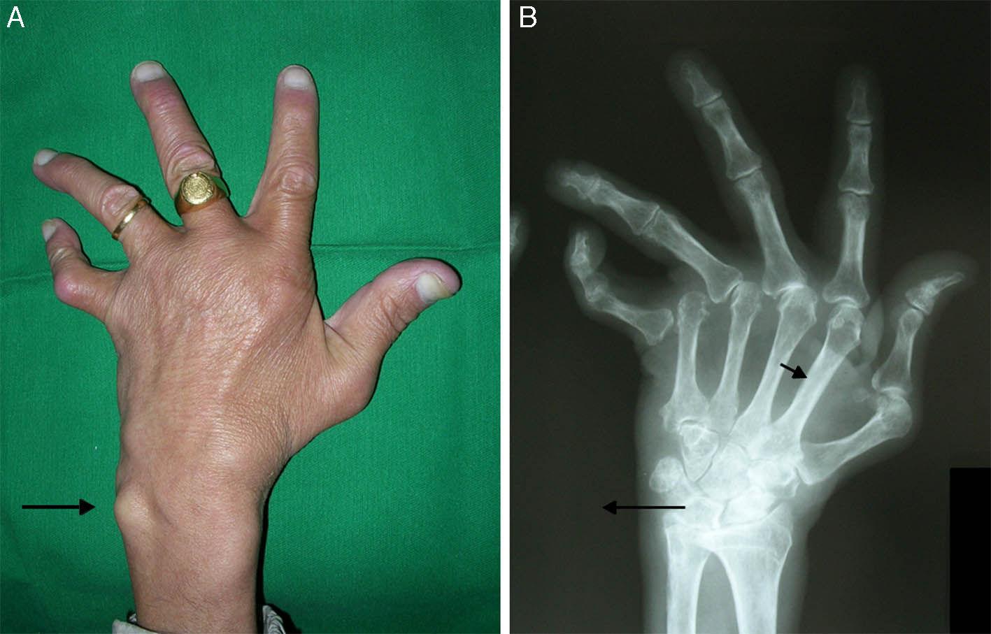 La muñeca reumatoidea. Aspectos esenciales en el tratamiento | Revista ...