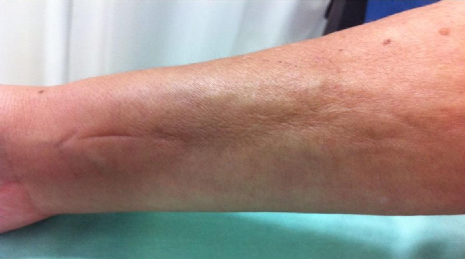 Fascitis eosinofílica: reporte de un caso | Revista Colombiana de ...