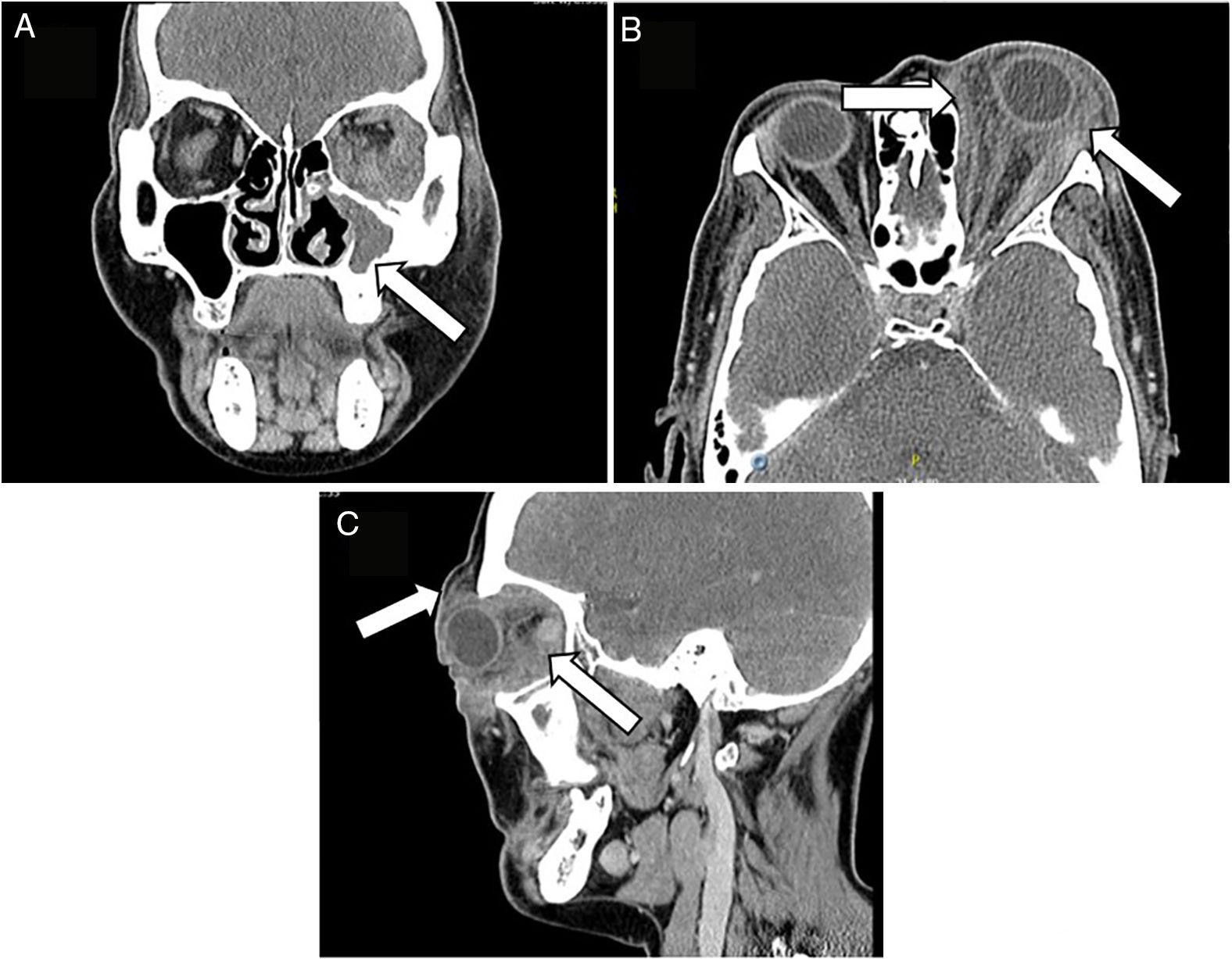 Proptosis ocular como una manifestación de la granulomatosis con ...