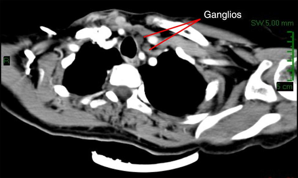 El SPECT/CT optimiza la técnica ROLL en cáncer tiroideo recurrente ...