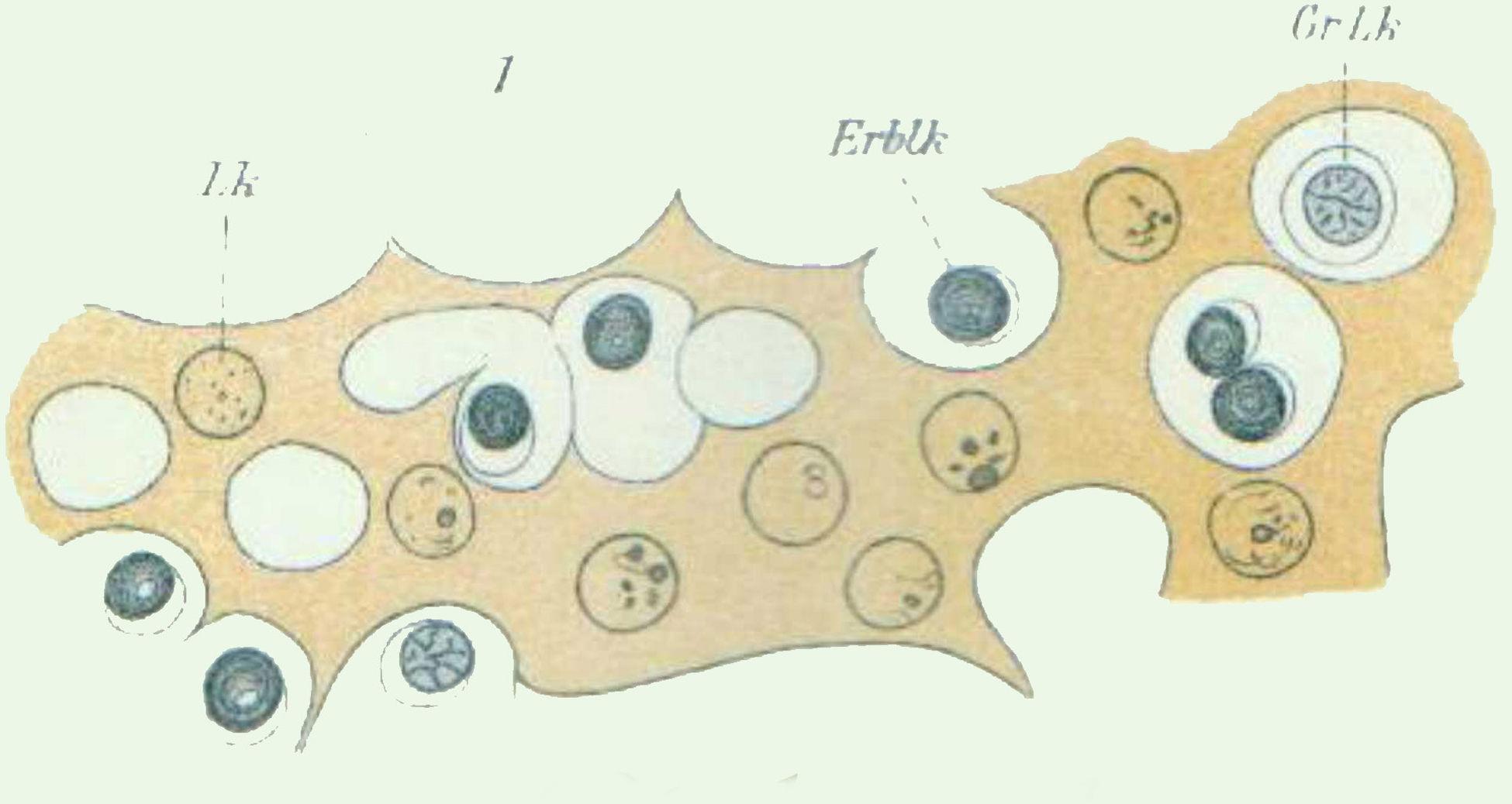 Morphology of leukaemias | Revista Médica del Hospital General de México