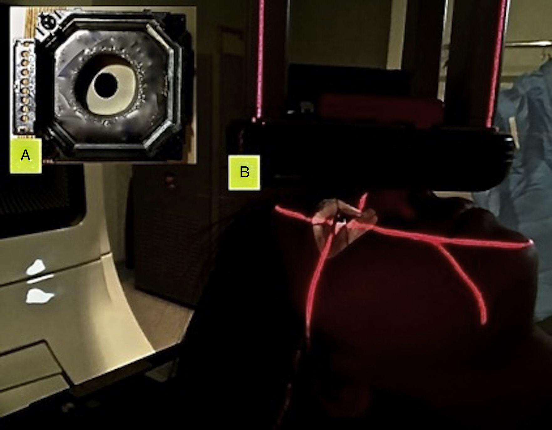 Results of radiotherapy in extranodal MALT lymphoma. A case report and ...