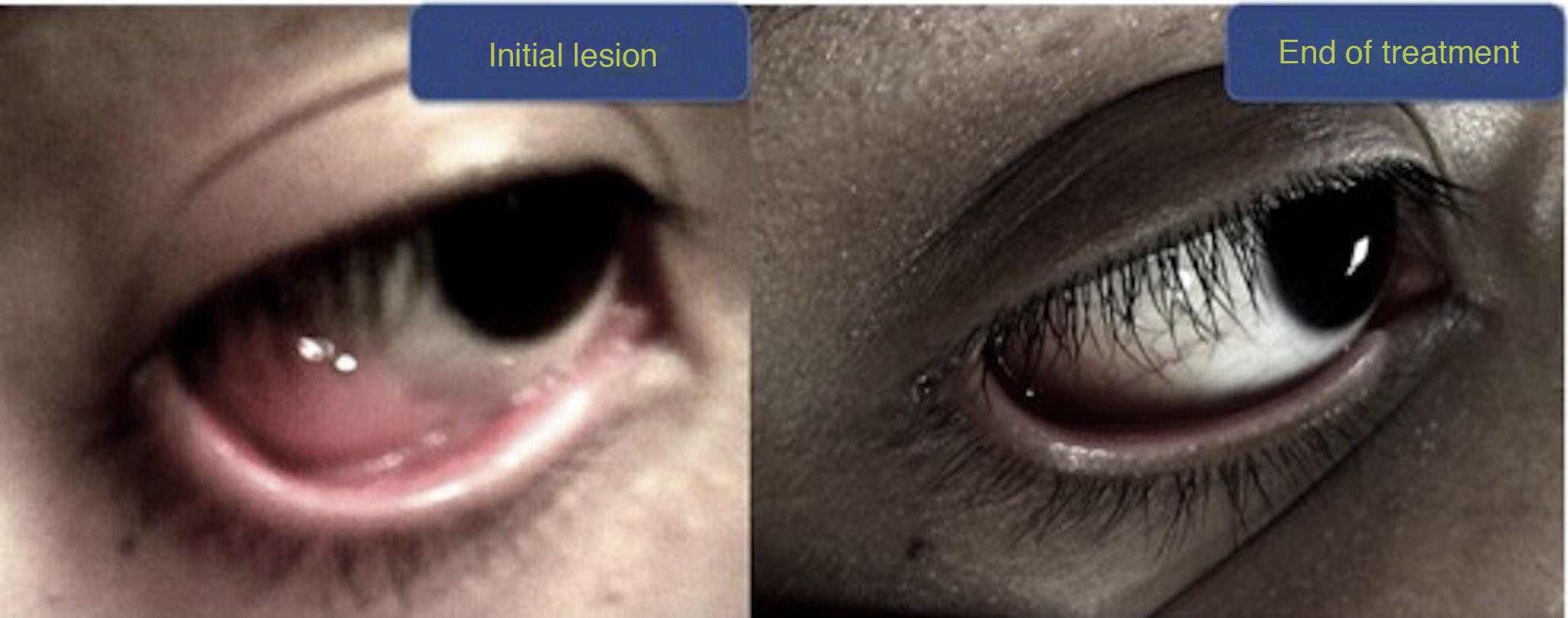 Conjunctival Lymphoma