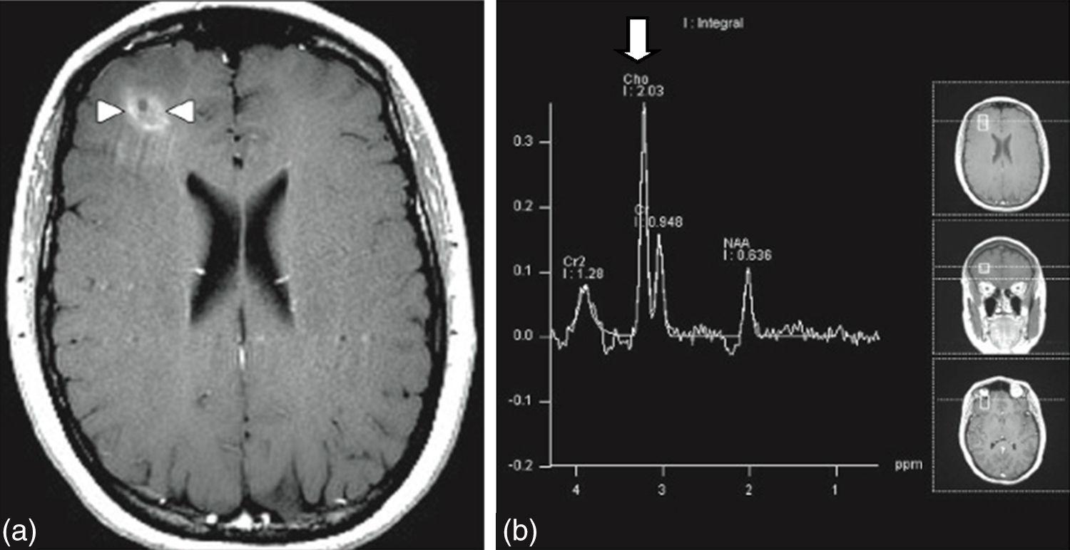 Brain metastases: Literature review | Revista Médica del Hospital ...