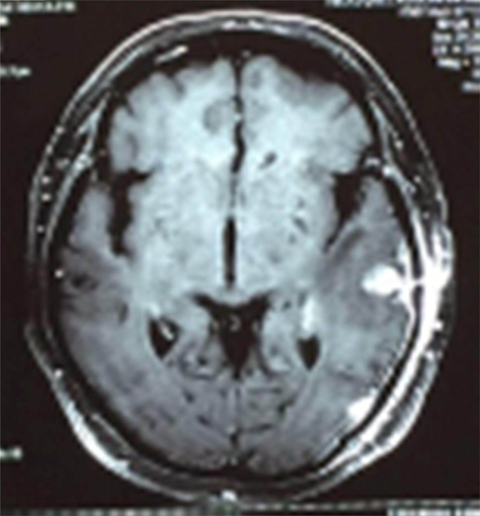Left temporal cerebral syphilitic gumma: Case report and literature ...