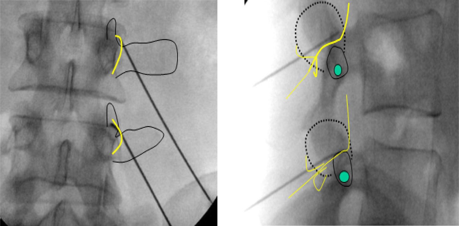 Radiofrequency thermocoagulation in chronic low back pain from the ...