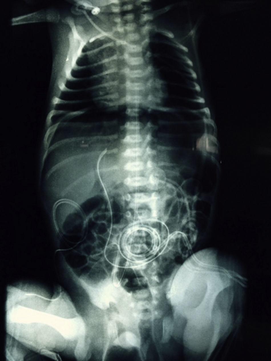 Neonatal gastric perforation: A case report | Revista Médica del ...