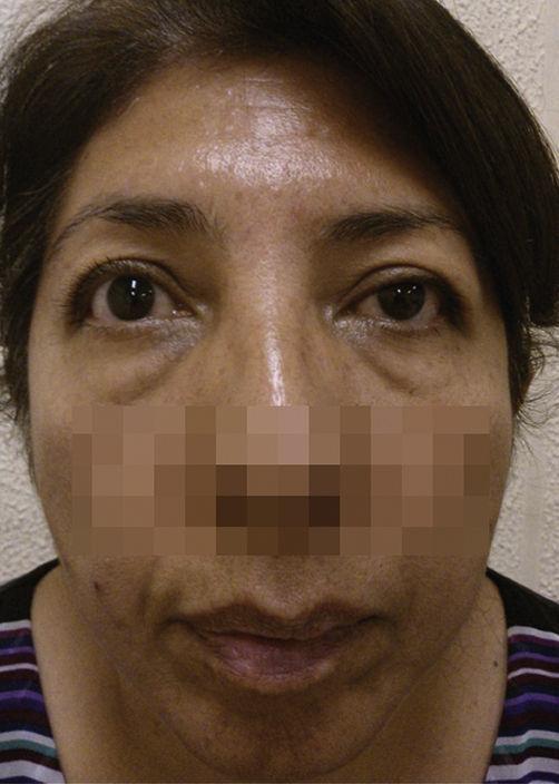 Síndrome de Marcos Gunn | Revista Mexicana de Oftalmología