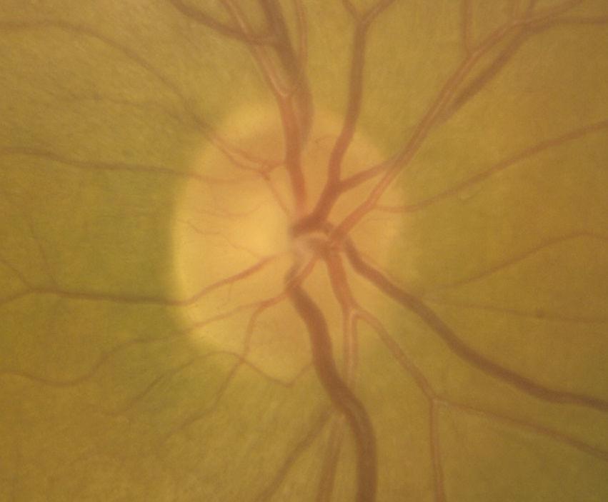 Edema de disco óptico en glaucoma primario por cierre angular agudo ...