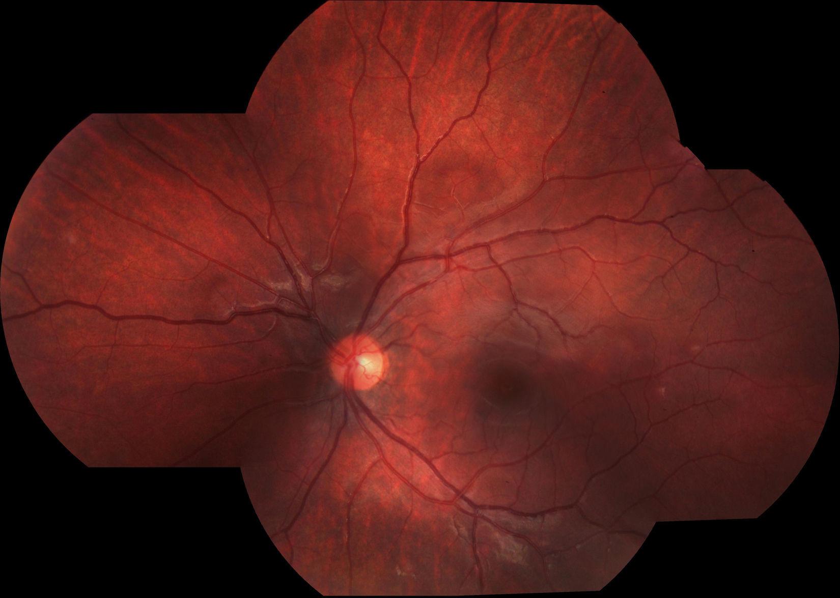 Neurorretinitis por Bartonella henselae: presentación de un caso y ...