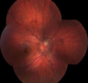 Neurorretinitis por Bartonella henselae: presentación de un caso y ...