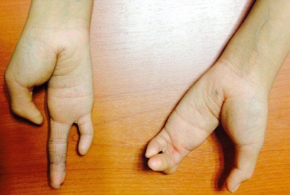 Síndrome de ectrodactilia-displasia ectodérmica-hendidura: reporte de ...