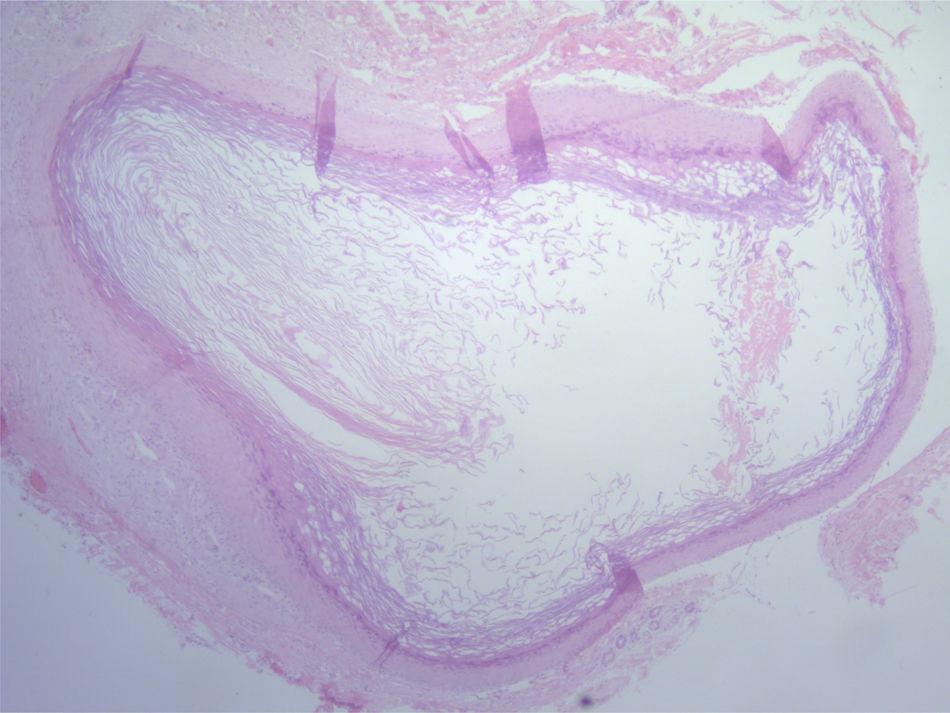 Quiste epidérmico de inclusión de párpado. Presentación de 2 casos ...