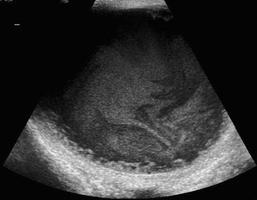 Hematocele | Actas Urológicas Españolas