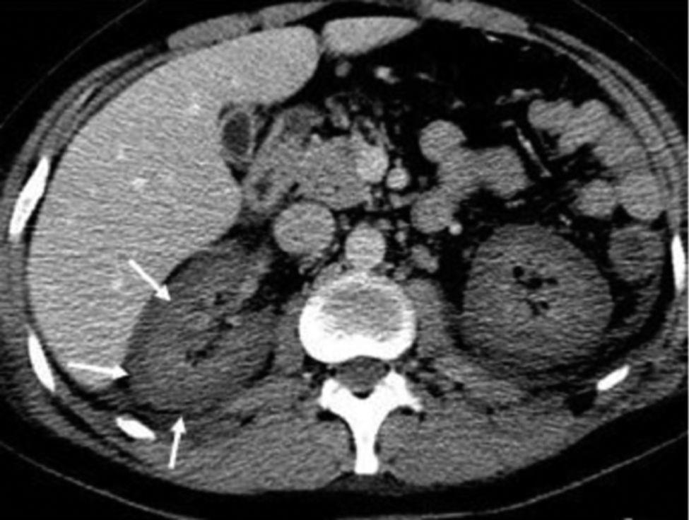 Necrosis cortical aguda bilateral y pancreatitis aguda grave | Medicina ...