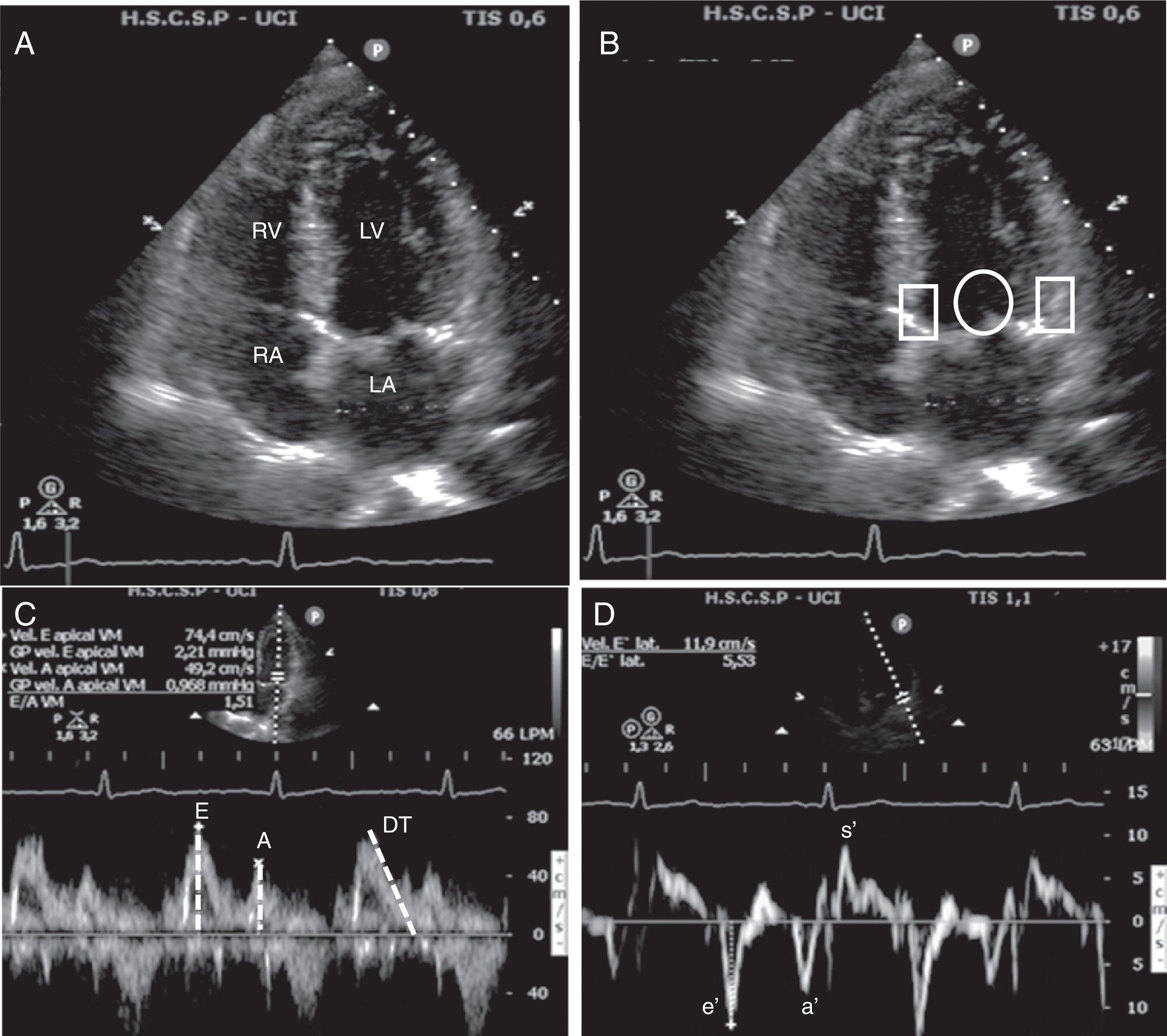 Diastolic dysfunction in the critically ill patient | Medicina Intensiva