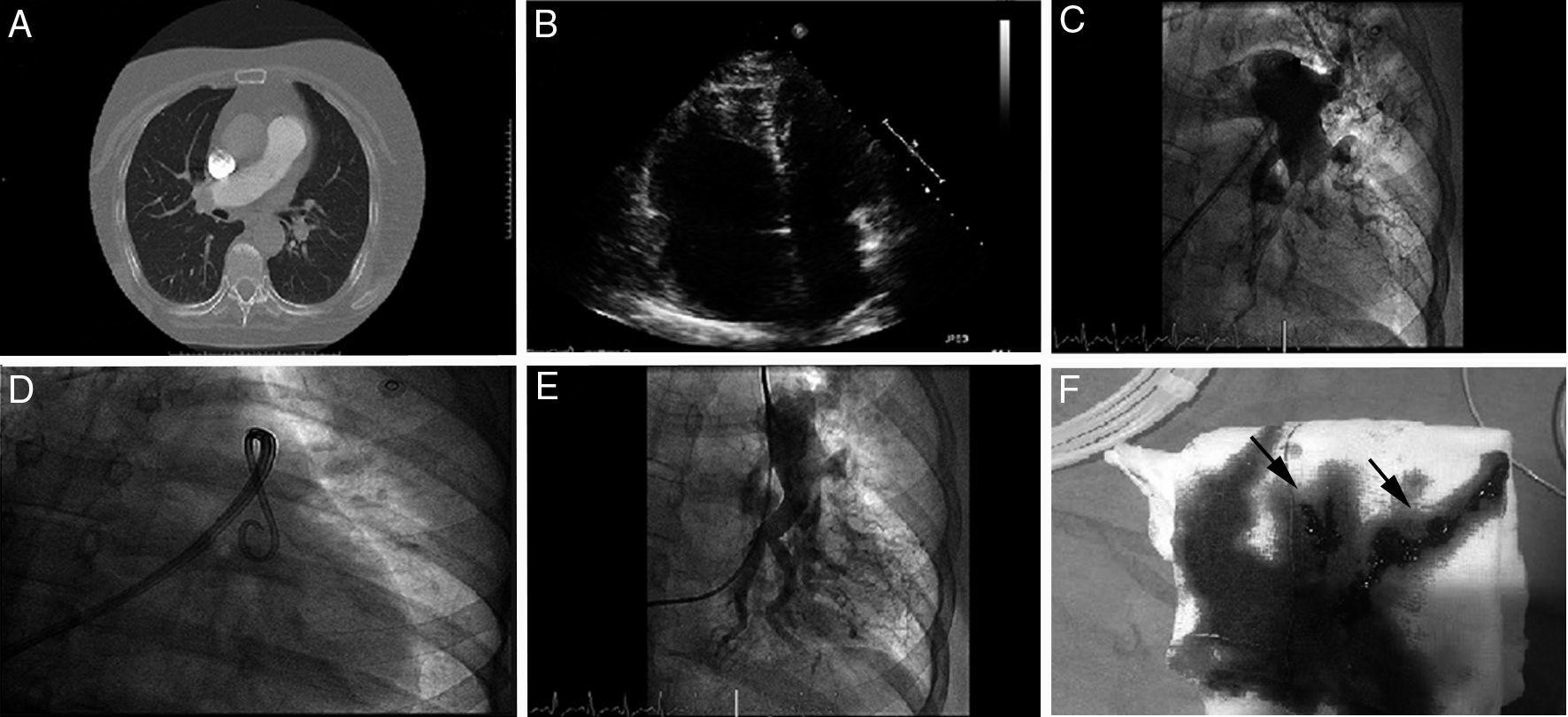 Tratamiento percutáneo del tromboembolismo pulmonar masivo | Medicina ...