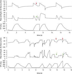 Double and multiple cycling in mechanical ventilation: Complex events ...