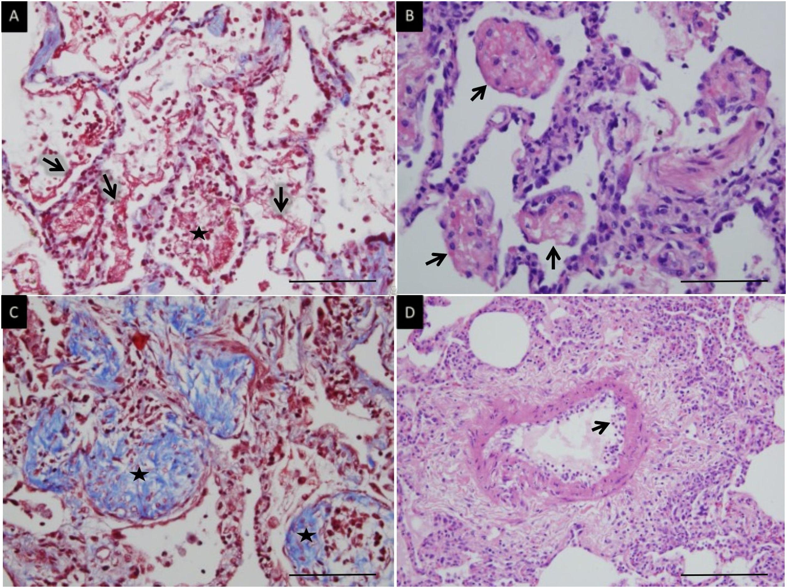 Respiratory Distress Syndrome Histology