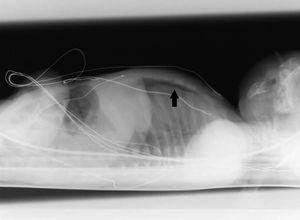 Diagnóstico de neumotórax, no visualizado en radiografía ...