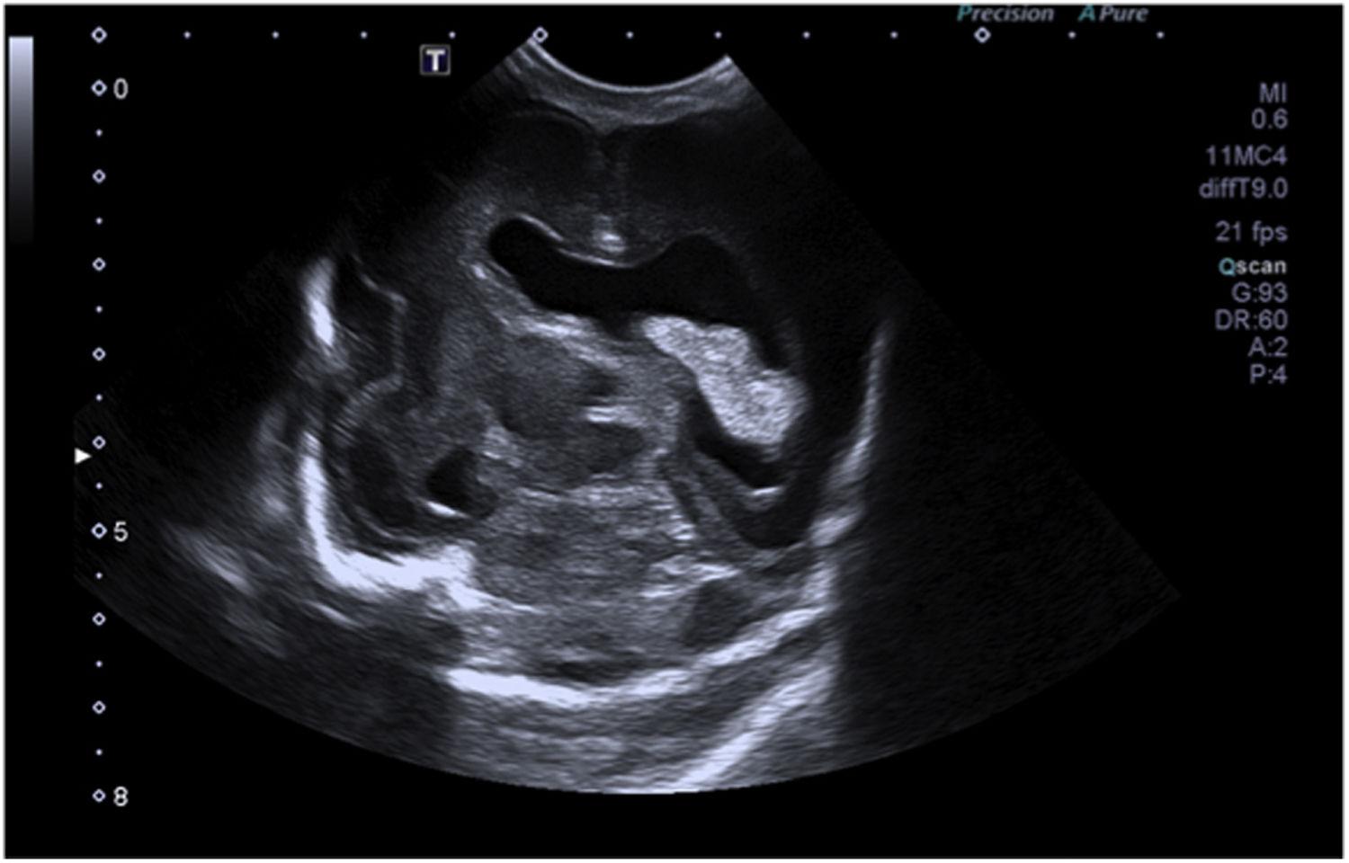 Point of care ultrasound to diagnose real-time intraventricular ...