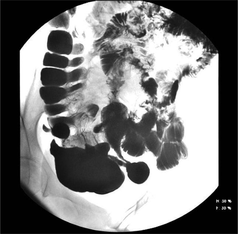 Mujer joven con enfermedad de crohn y gas portal | Gastroenterología y ...
