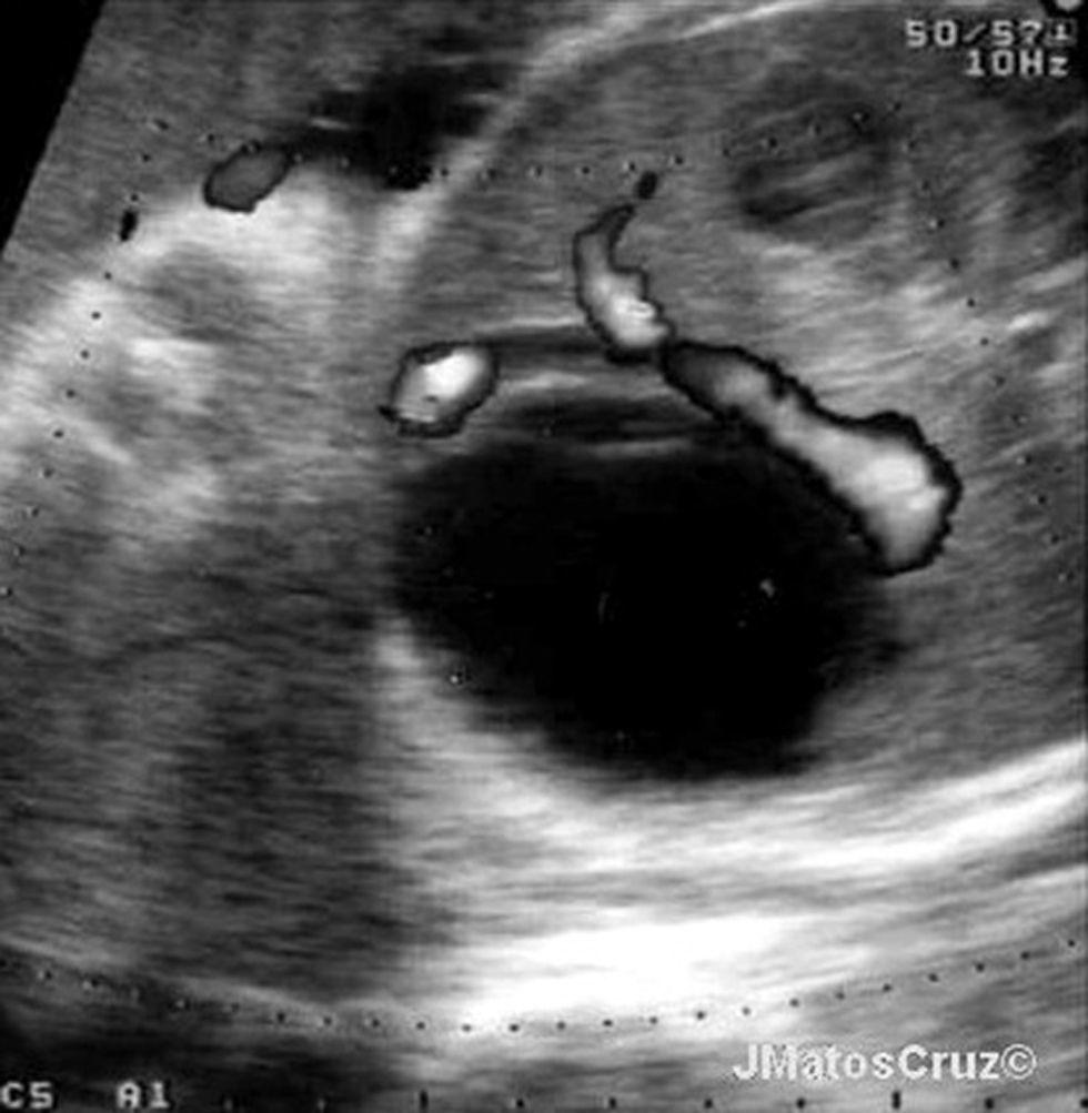 Quiste hepático simple congénito: un desafío diagnóstico y terapéutico ...