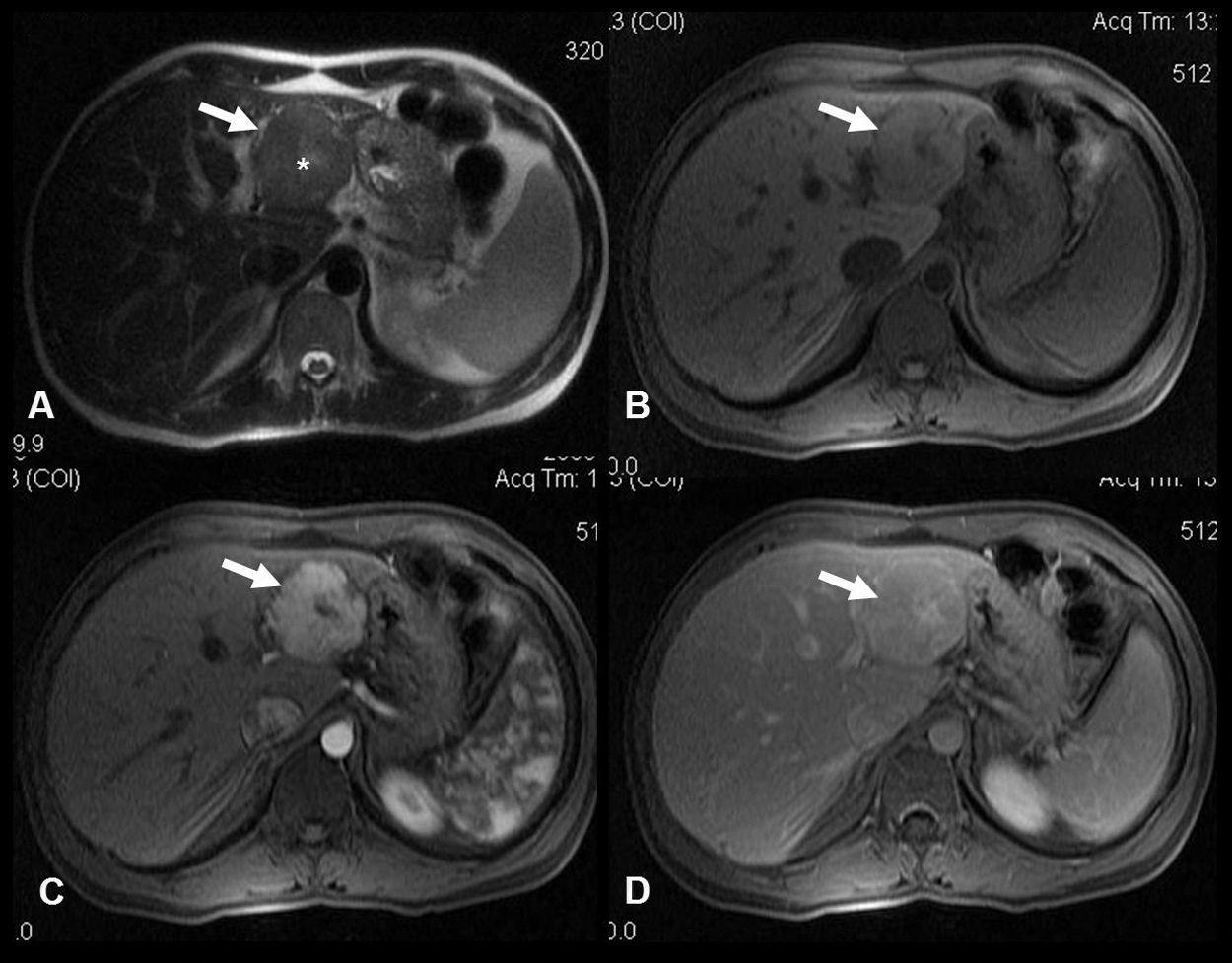 Tumores benignos del hígado | Gastroenterología y Hepatología