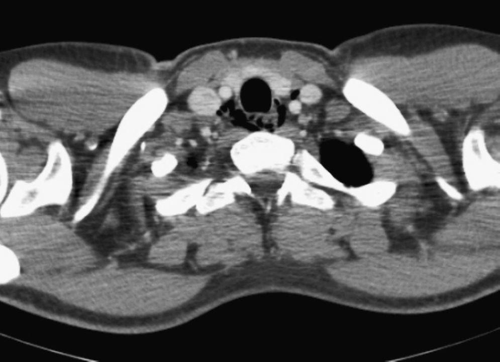 Perforación esofágica tras biopsia en paciente con esofagitis ...