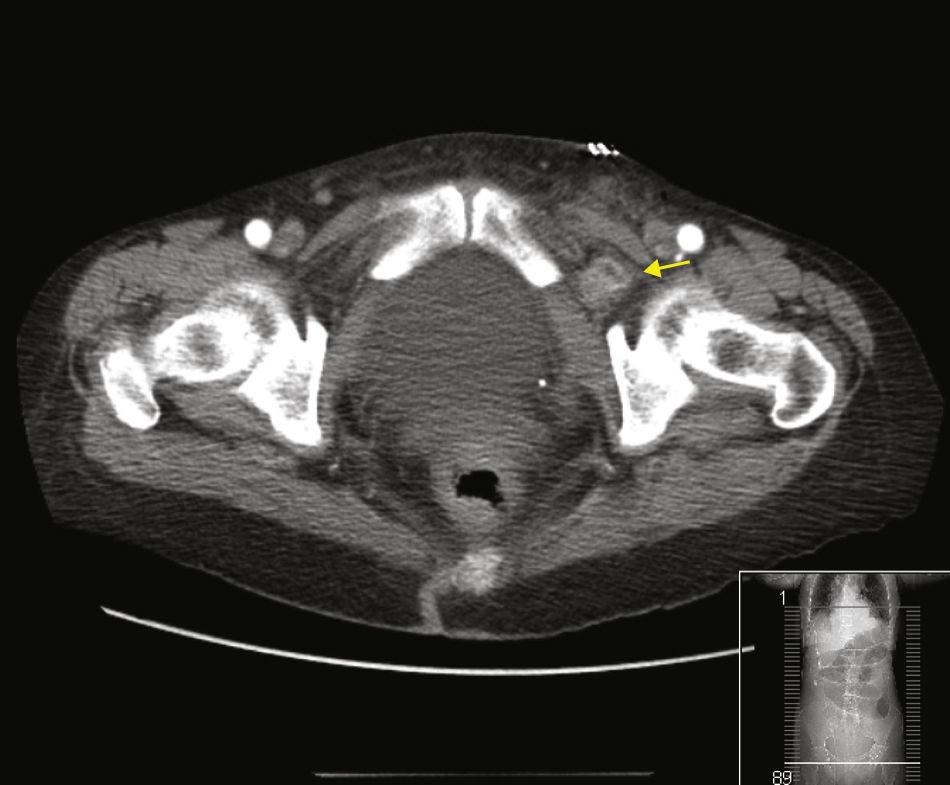 Obstrucción intestinal en una anciana por hernia obturatriz ...