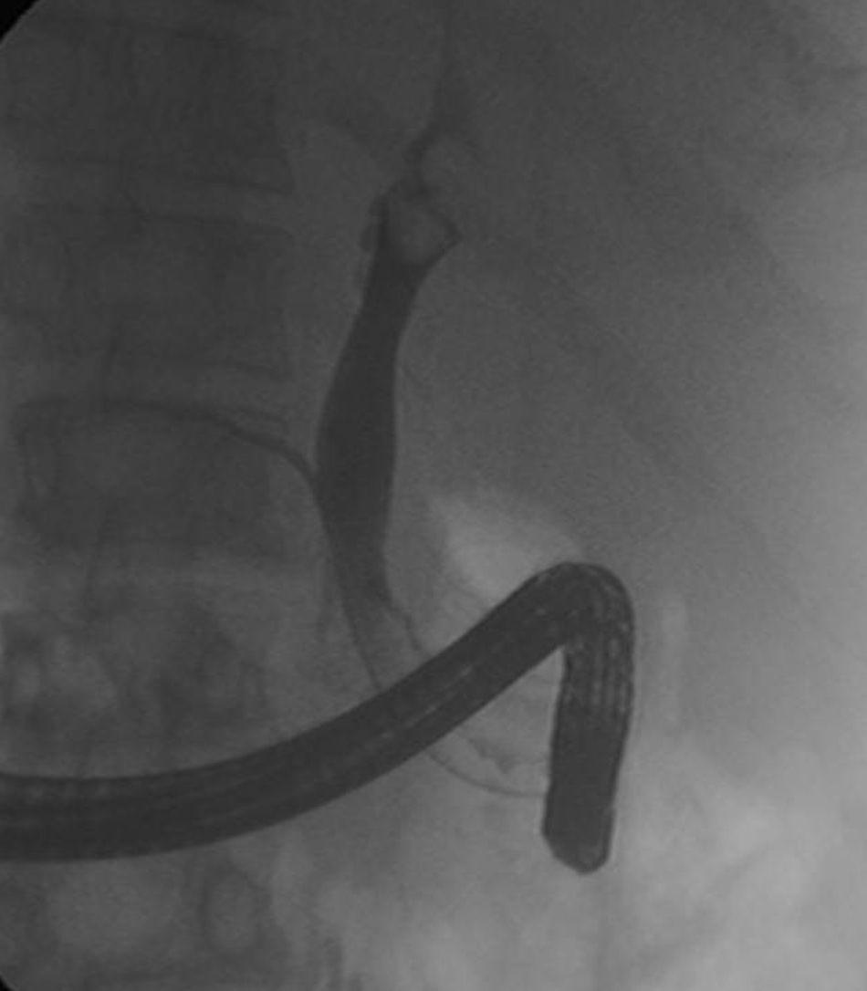 Bile duct hepatocellular carcinoma thrombi | Gastroenterología y ...