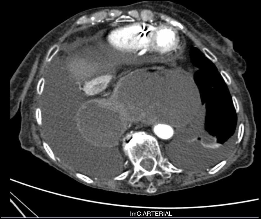 Vólvulo gástrico agudo: la importancia del diagnóstico precoz ...