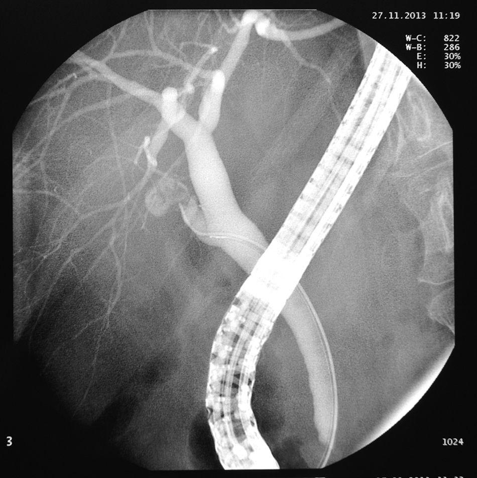 Síndrome del muñón cístico como causa de síndrome poscolecistectomía ...