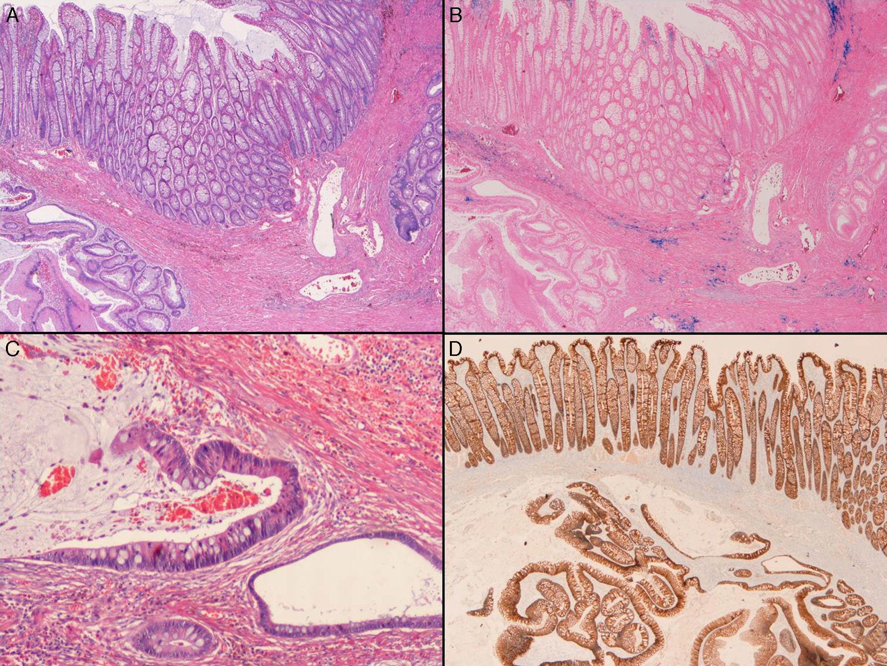 Adenoma with pseudoinvasion – A crucial differential diagnosis for ...