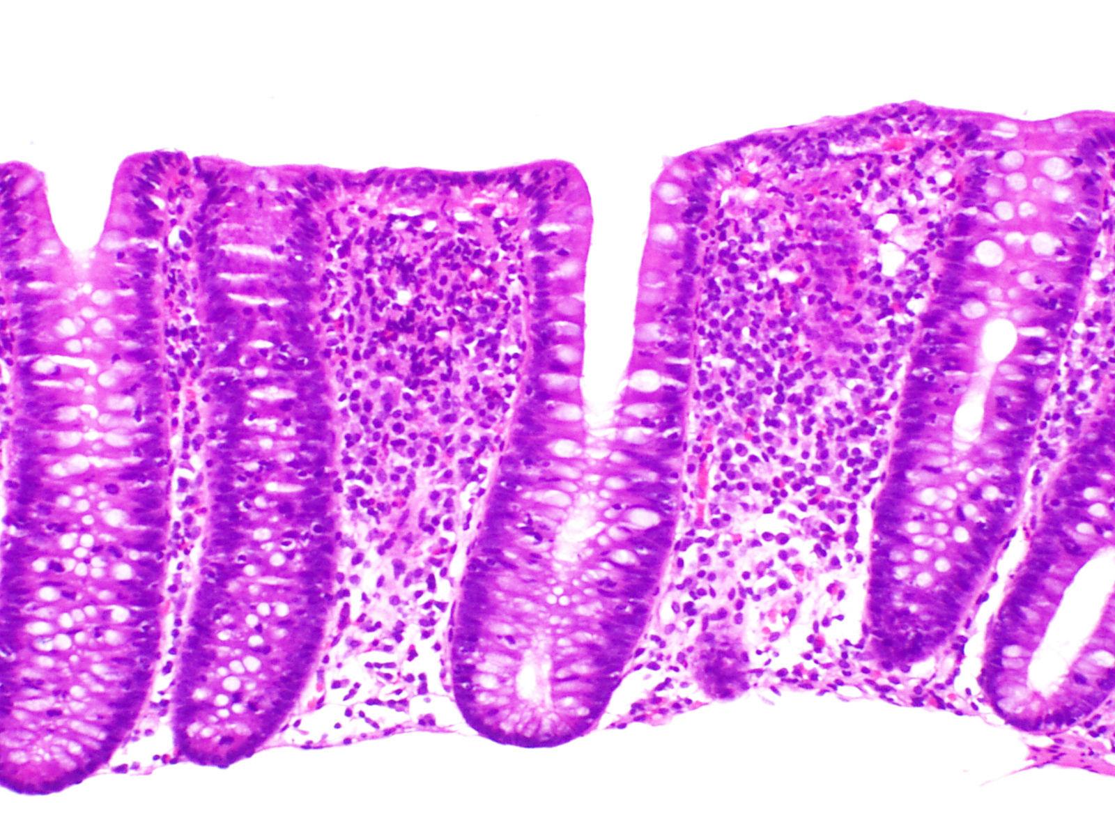Colitis microscópica: avances para una mejor identificación en los ...
