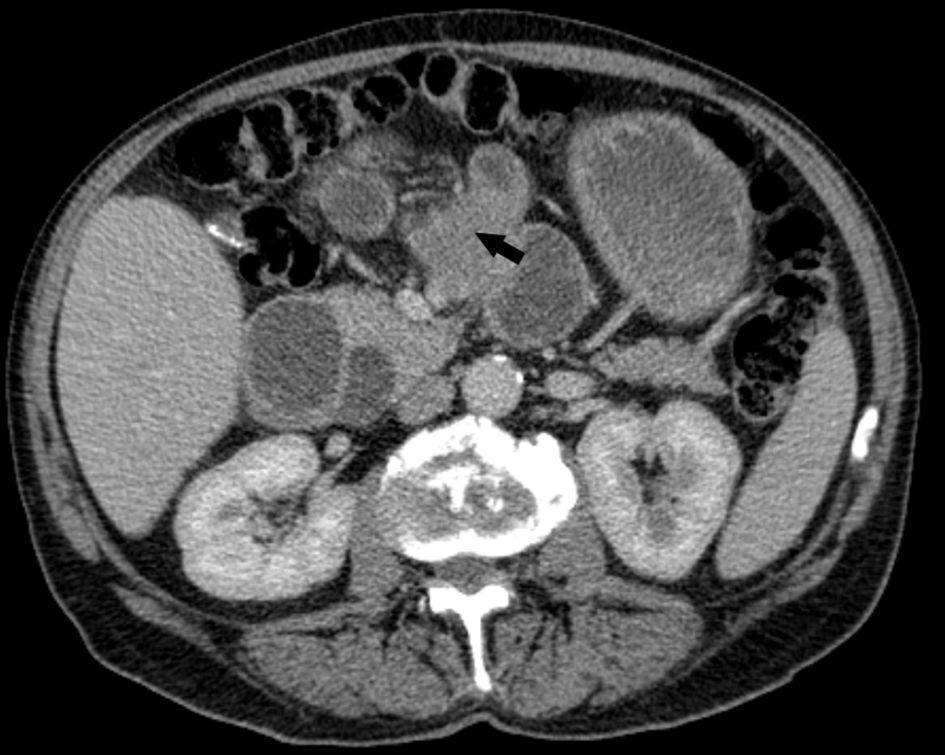 Palliative stenting of a jejunal stricture secondary to malignant ...
