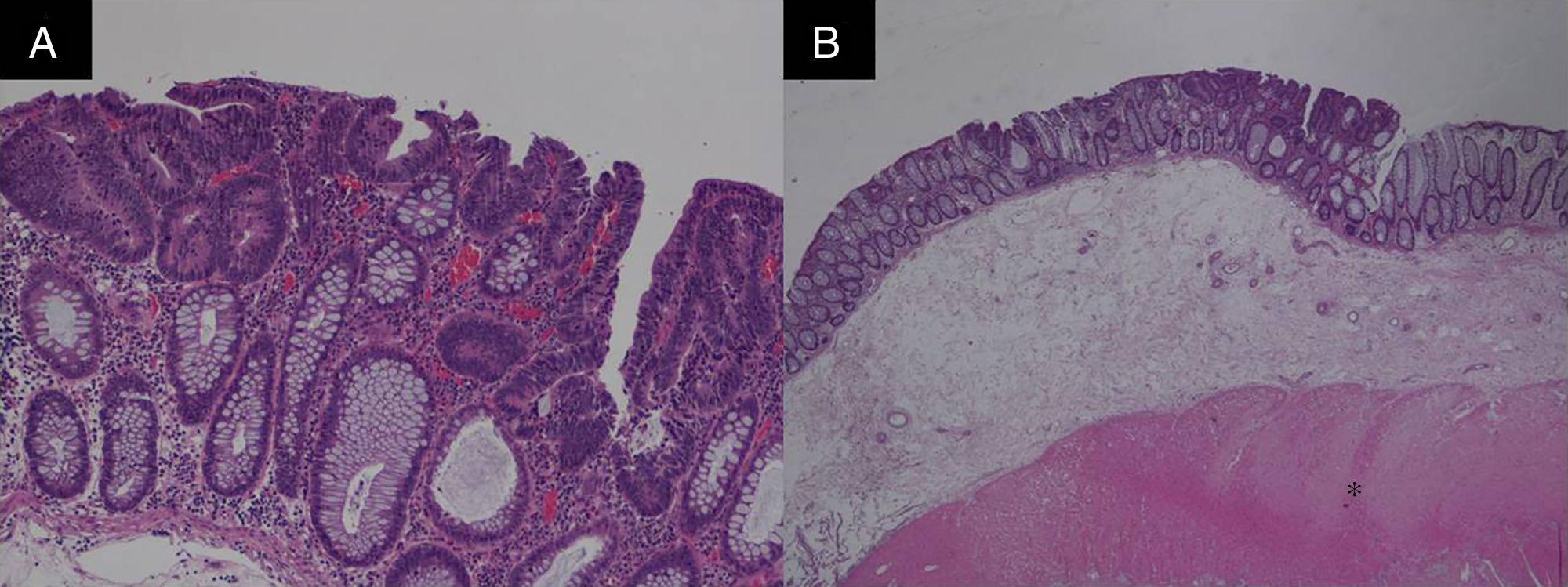 Target sign: An important diagnostic tool | Gastroenterología y Hepatología
