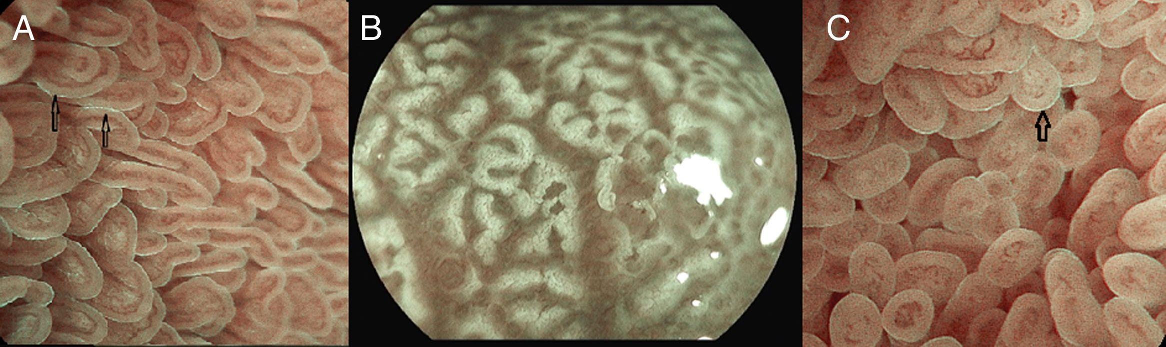 Endoscopic microanatomy of the normal gastrointestinal mucosa with ...