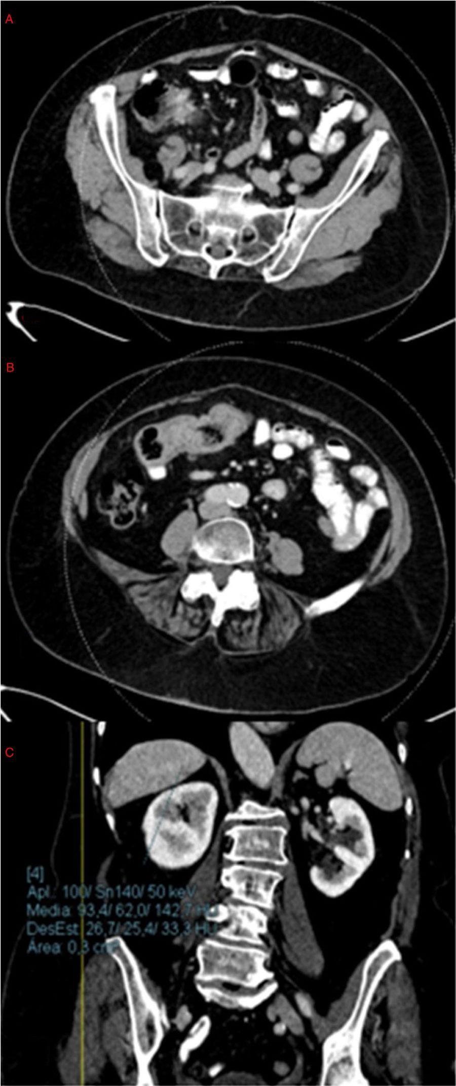 Doble metástasis hepática de doble neoplasia de colon: adenocarcinoma y ...