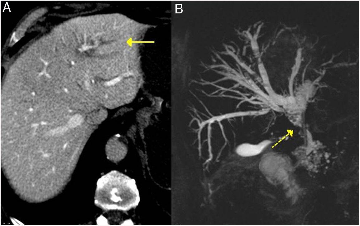 Colangitis esclerosante relacionada con IgG4. A) Imagen de TC: se ...