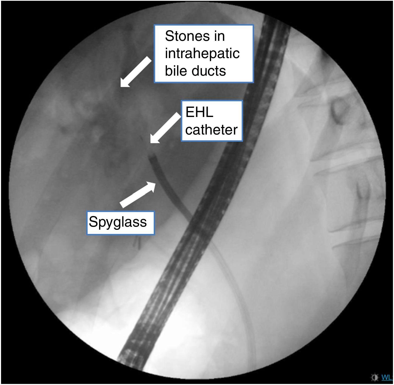 New management of hepatolithiasis: Can surgery be avoided? (with video ...