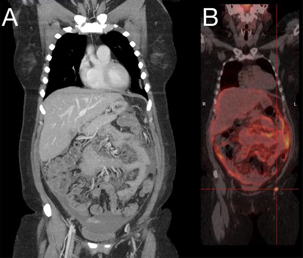 Tuberculosis peritoneal que simula una carcinomatosis: a propósito de ...