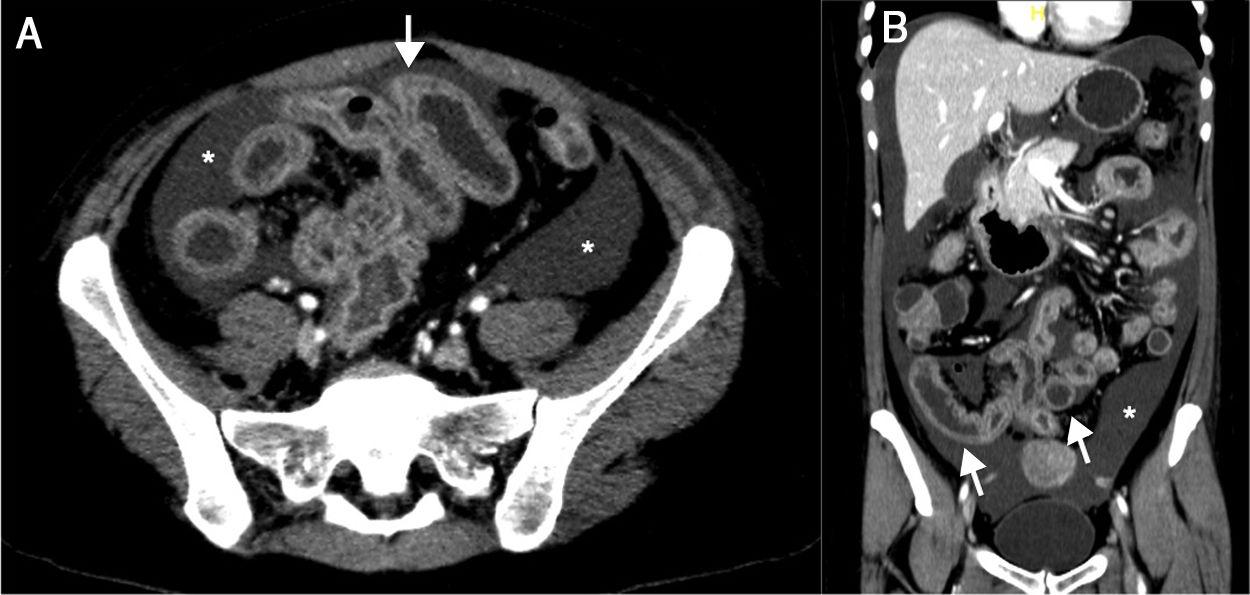 Gastroenteritis eosinofílica: una misma entidad con distintas ...