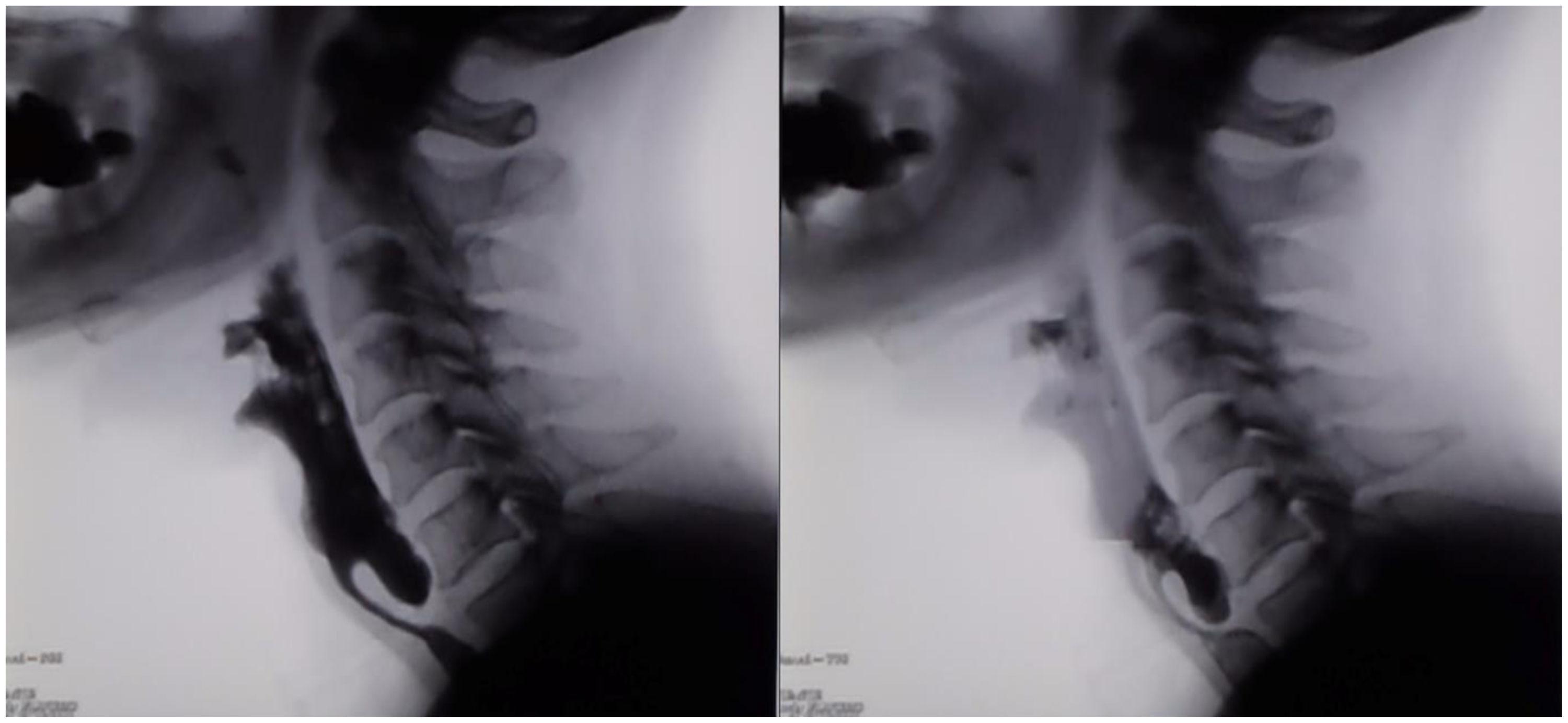 Manometría de alta resolución con impedancia para el estudio de la ...