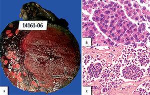 Disgerminoma «anaplásico» de ovario en una mujer de 23 años de edad ...