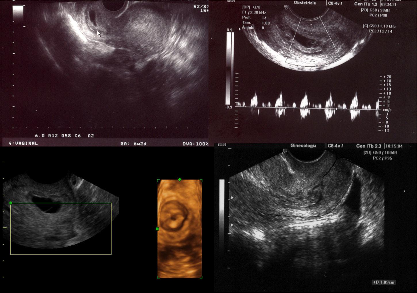 Diagnóstico precoz del embarazo cervical: factor más importante para la ...