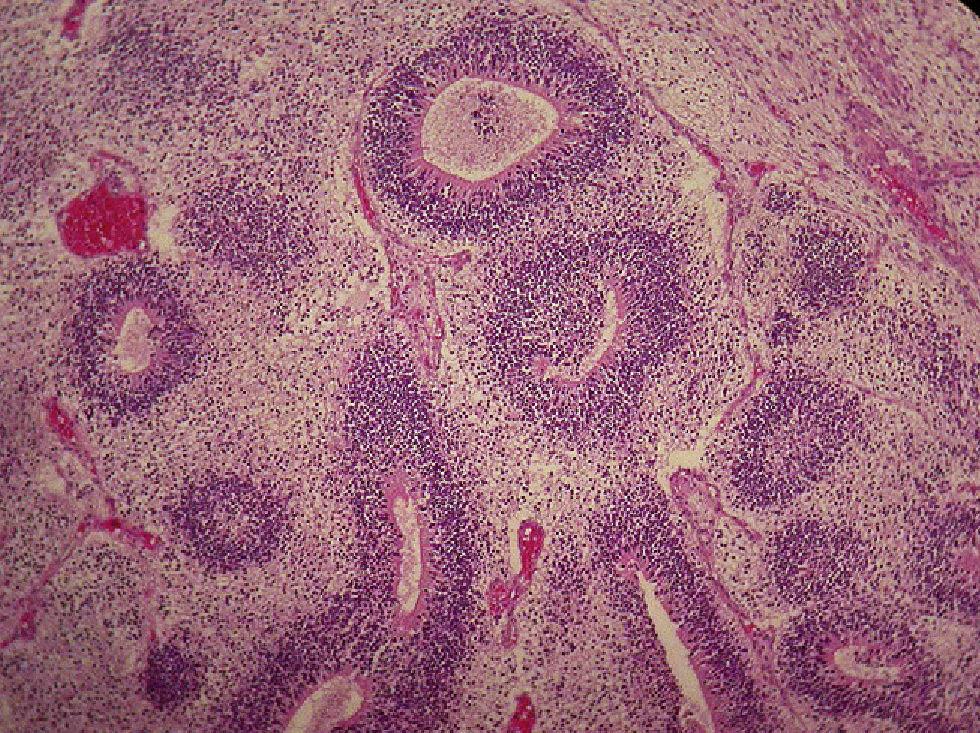 Diagnóstico prenatal de tumores congénitos intracraneales: teratoma ...