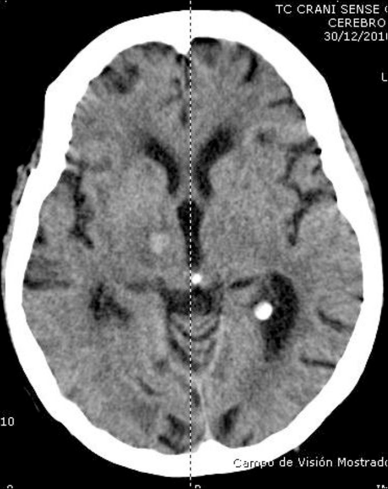 Hemibalismo de etiología vascular. Abordaje farmacológico-rehabilitador ...