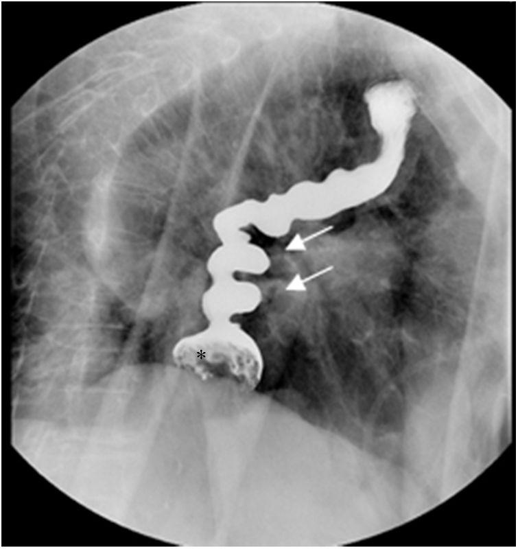 Bezoar esofágico en paciente con espasmo esofágico difuso | Revista ...