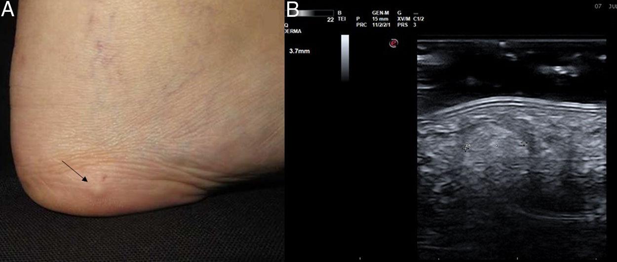Pápulas piezogénicas: descripción ecográfica | Revista Española de ...